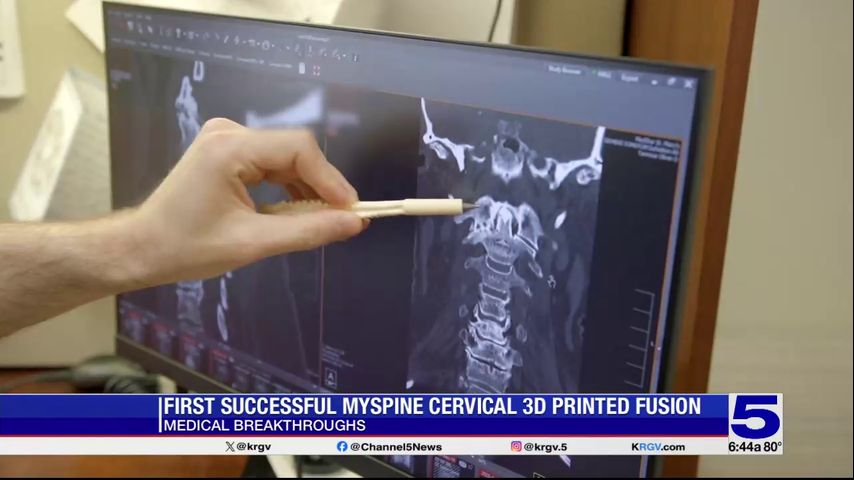 Medical Breakthroughs: First successful MySpine cervical 3D printed fusion