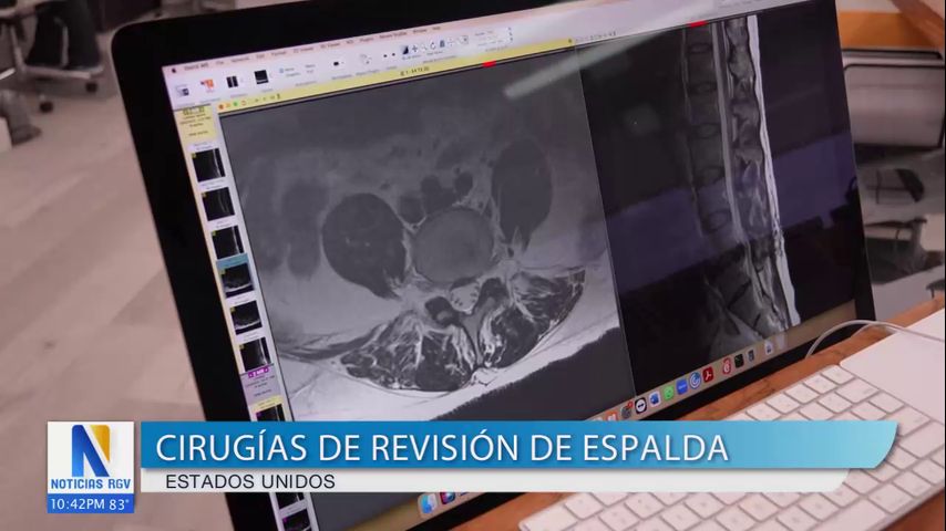 Salud y Vida: Aumentan los casos de síndrome de espalda fallida en EE.UU.