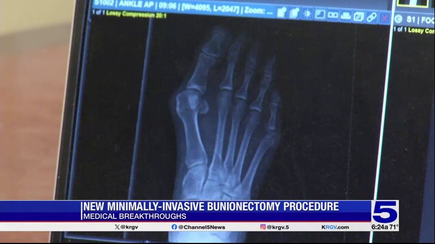Medical Breakthrough: New minimally-invasive bunionectomy procedure