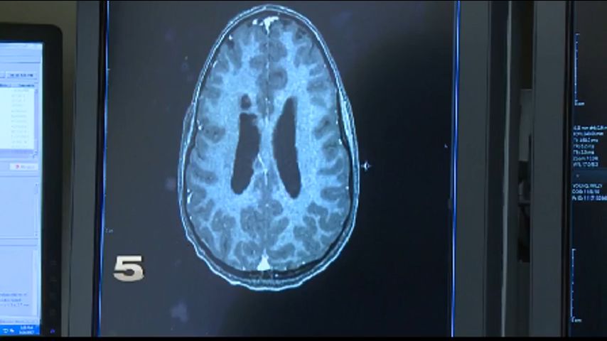 VA: Brain Donations from Women Needed for PTSD Research