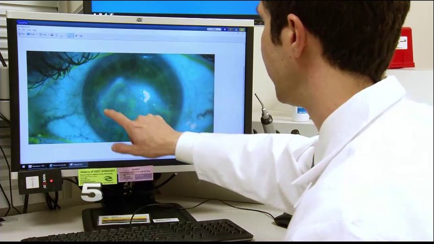 Medical Breakthrough: Corneal Transplants Reverse Shingles-Related ...