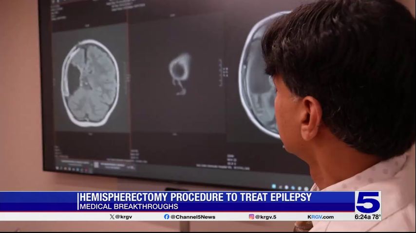 Medical Breakthroughs: Hemispherectomy procedure to treat epilepsy