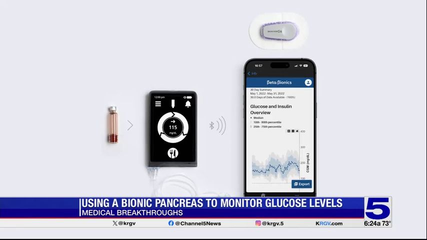 Medical Breakthroughs: Using a bionic pancreas to monitor glucose levels